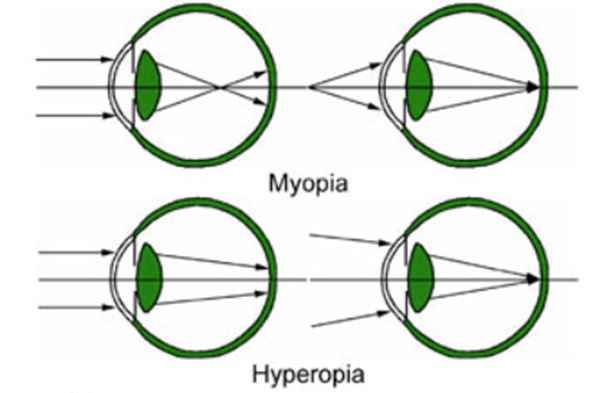 Ametropic Eye Model with CAD Lens in Zemax