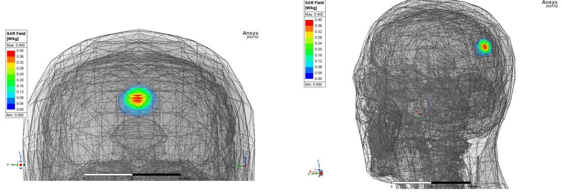 Wireless Power Transfer and SAR Simulation of Implantable Medical ...