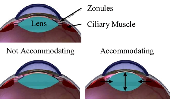 Intraocular Lens: From Technique to Market