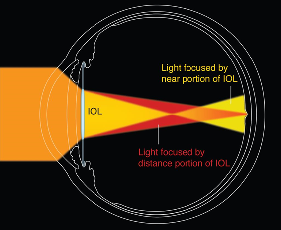 Bi-focal Intraocular lens in Zemax